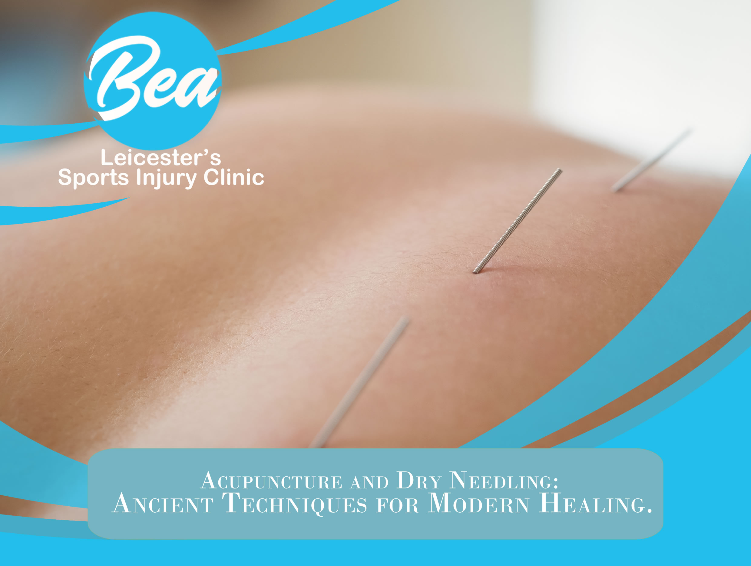 Ancient Techniques for Modern Healing - Bea Sports Injury Clinics